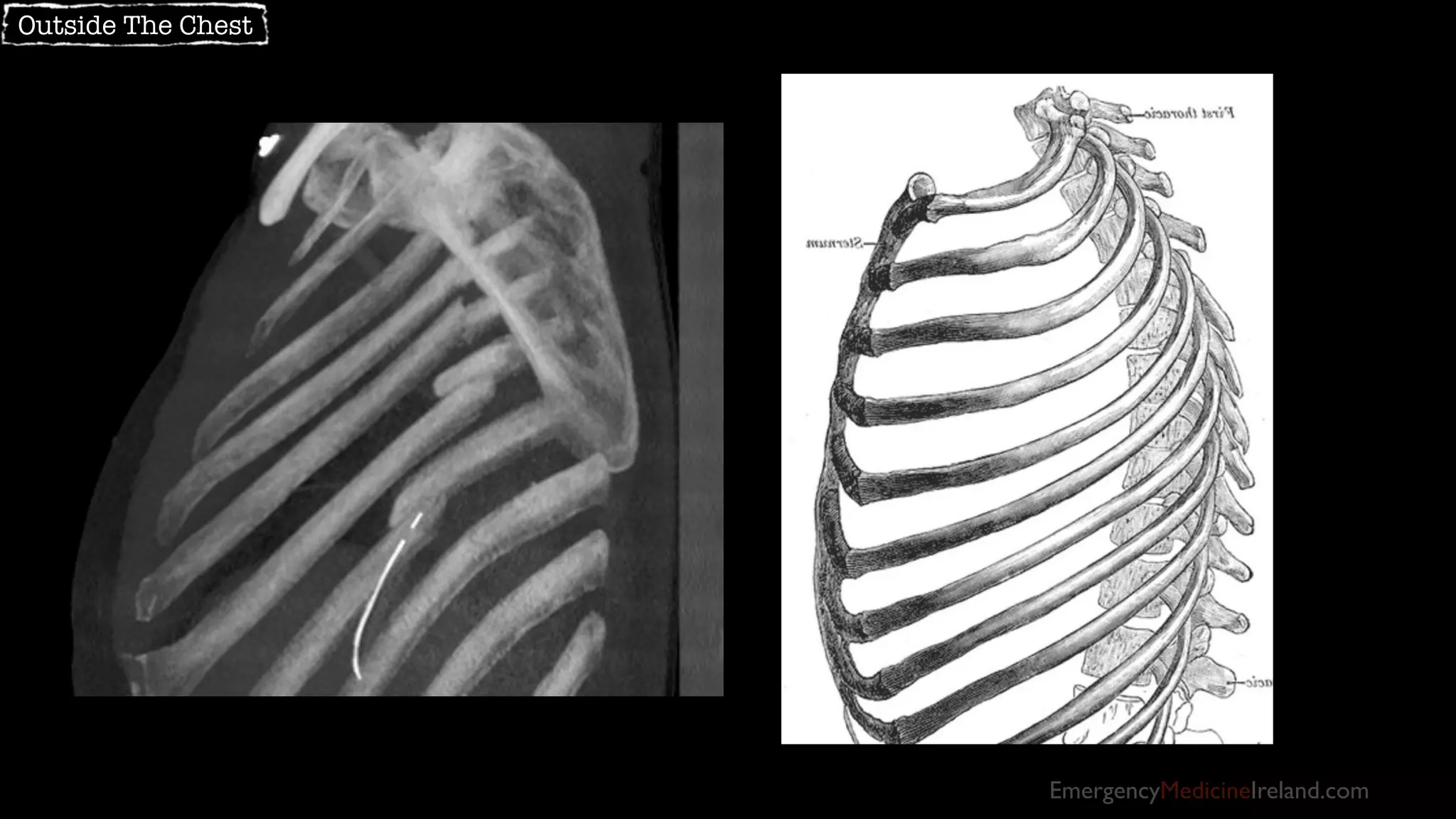 TCD Lecture: basic anatomy of chest and abdominal trauma | PDF