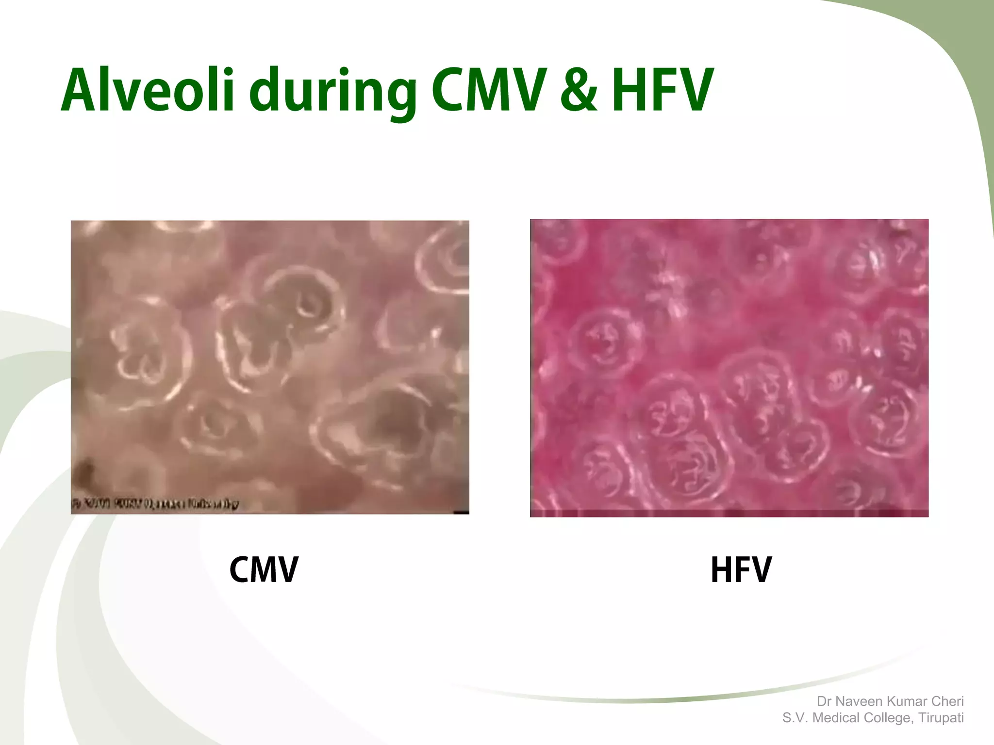 HFOV - High Frequency Oscillatory Ventilation | PDF