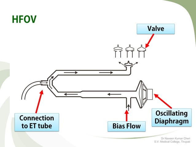 HFOV - High Frequency Oscillatory Ventilation