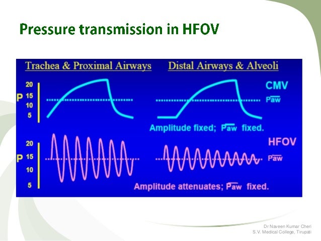 HFOV - High Frequency Oscillatory Ventilation