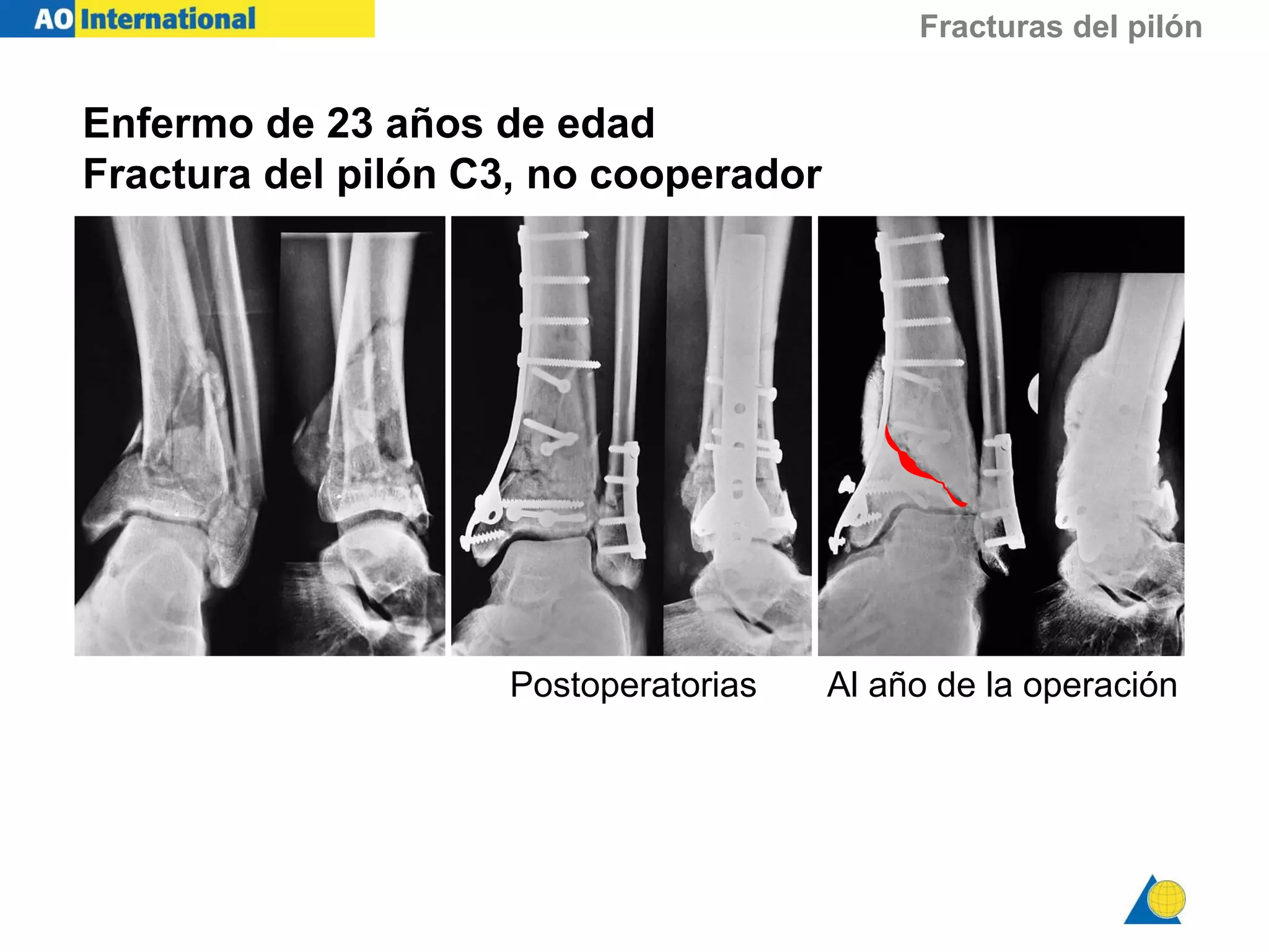 Fracturas del pilón tibial | PPT