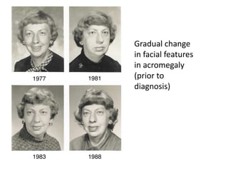 8L, Acromegaly-1.pptx