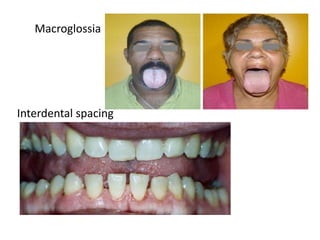 Macroglossia Acromegaly