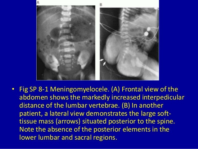 8 localized widening of the interpedicular distance