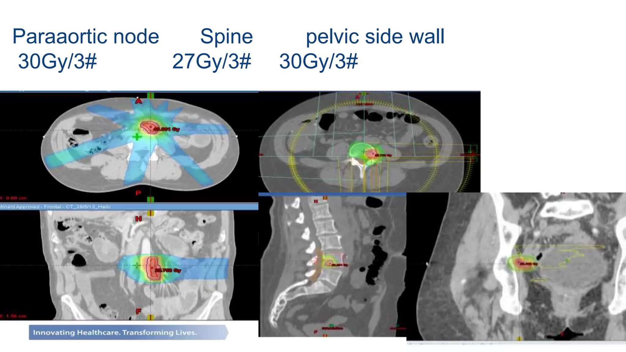 Professor Maria Hawkins - UK SABR Service Development Experiences | PPTX