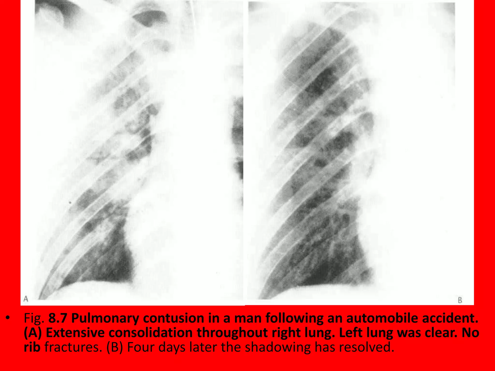 8 miscellaneous chest conditions | PPTX | Death, Injury, or Military ...