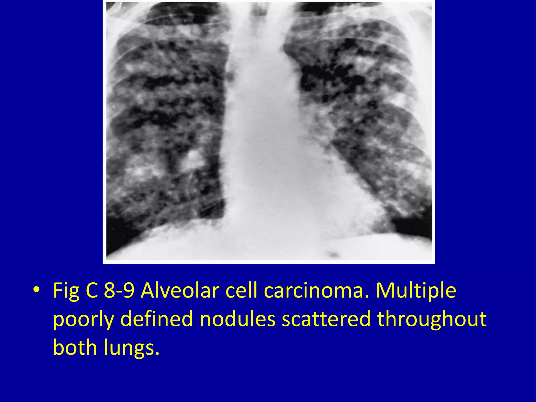 8 multiple pulmonary nodules copy | PPTX