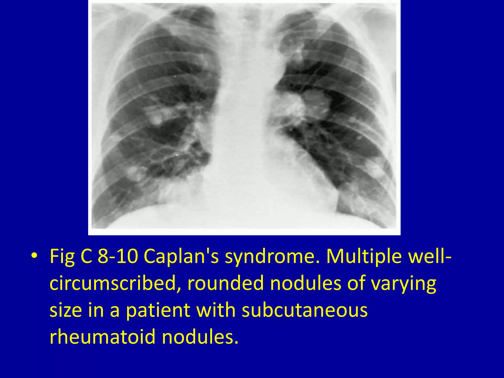 8 multiple pulmonary nodules copy | PPTX