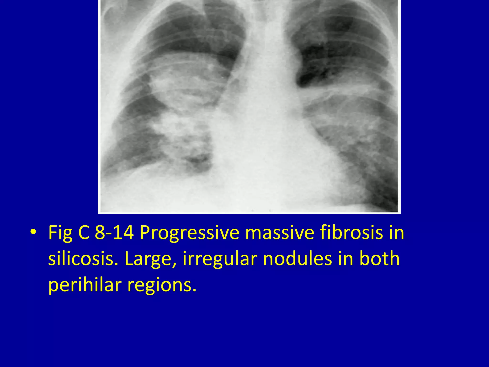 8 multiple pulmonary nodules copy | PPTX