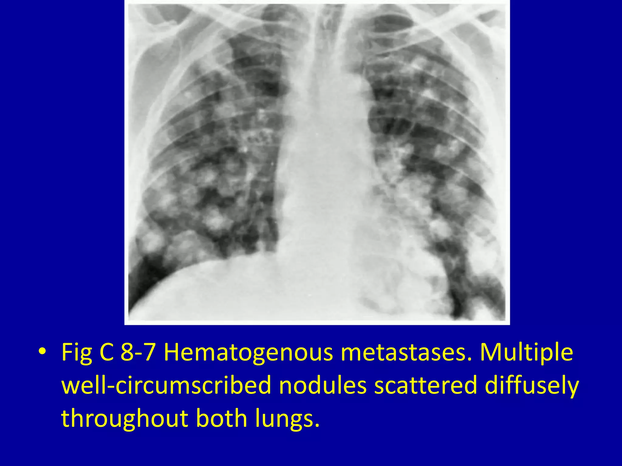 8 multiple pulmonary nodules copy | PPTX