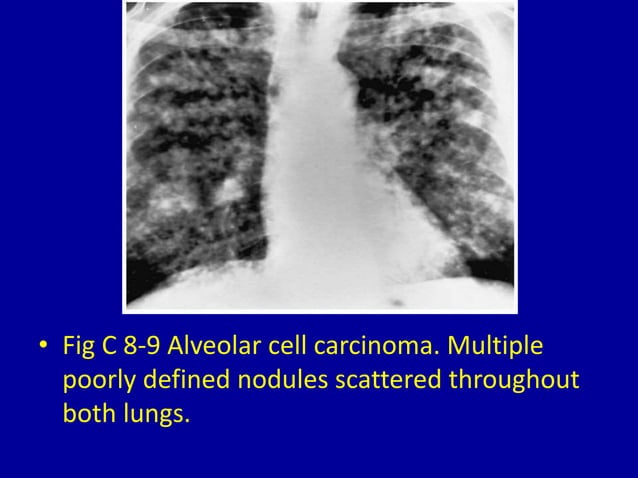 8 multiple pulmonary nodules copy | PPTX | Lung and Respiratory Health ...