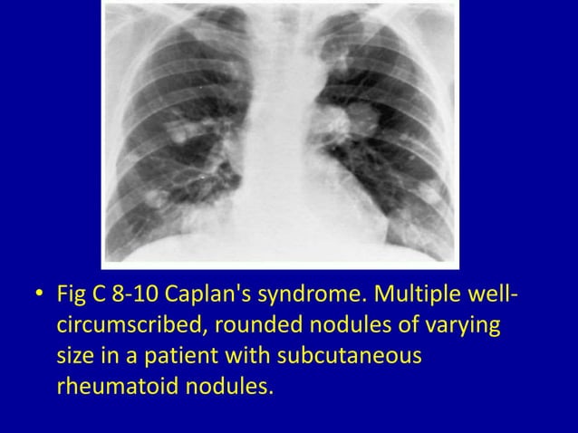 8 multiple pulmonary nodules copy | PPTX | Lung and Respiratory Health ...