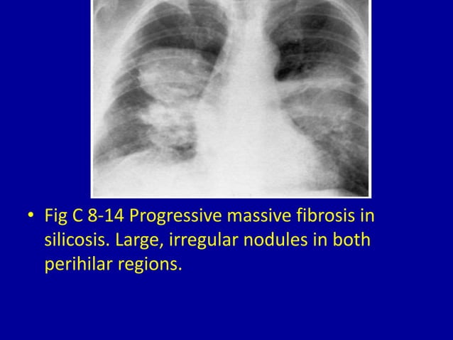 8 multiple pulmonary nodules copy | PPTX | Lung and Respiratory Health ...