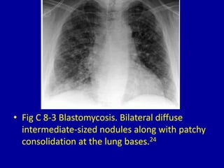 8 multiple pulmonary nodules copy | PPTX