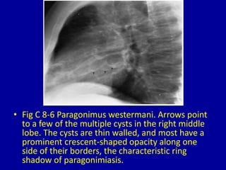 8 multiple pulmonary nodules copy | PPTX
