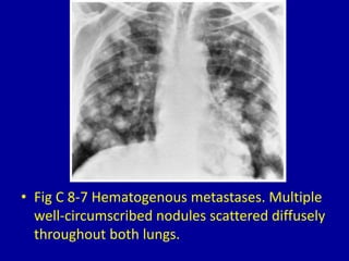8 multiple pulmonary nodules copy | PPTX