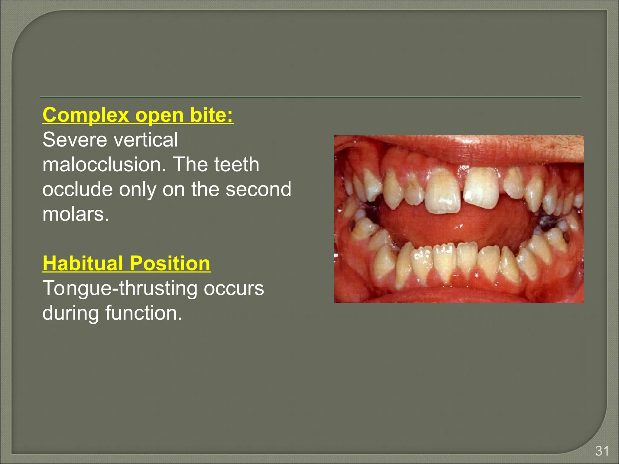 OPENBITE IN ORTHODONTICS-ETIOLOGY, DIAGNOSIS & MANAGEMENT .ppt