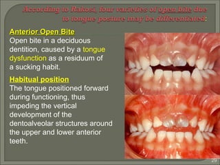 OPENBITE IN ORTHODONTICS-ETIOLOGY, DIAGNOSIS & MANAGEMENT .ppt