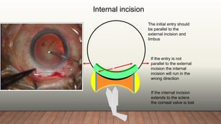 SICS WOUND CONSTRUCTION _ Beginner's Guide | PPTX