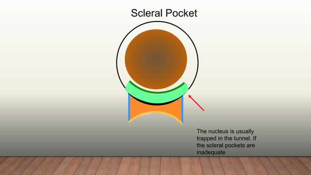 SICS WOUND CONSTRUCTION _ Beginner's Guide | PPTX