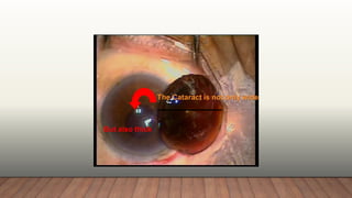 SICS WOUND CONSTRUCTION _ Beginner's Guide | PPTX