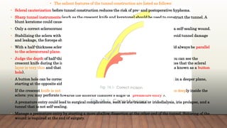 SICS WOUND CONSTRUCTION _ Beginner's Guide | PPTX