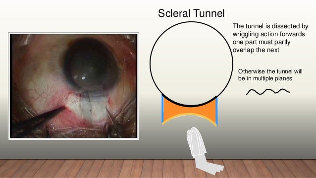 SICS WOUND CONSTRUCTION _ Beginner's Guide