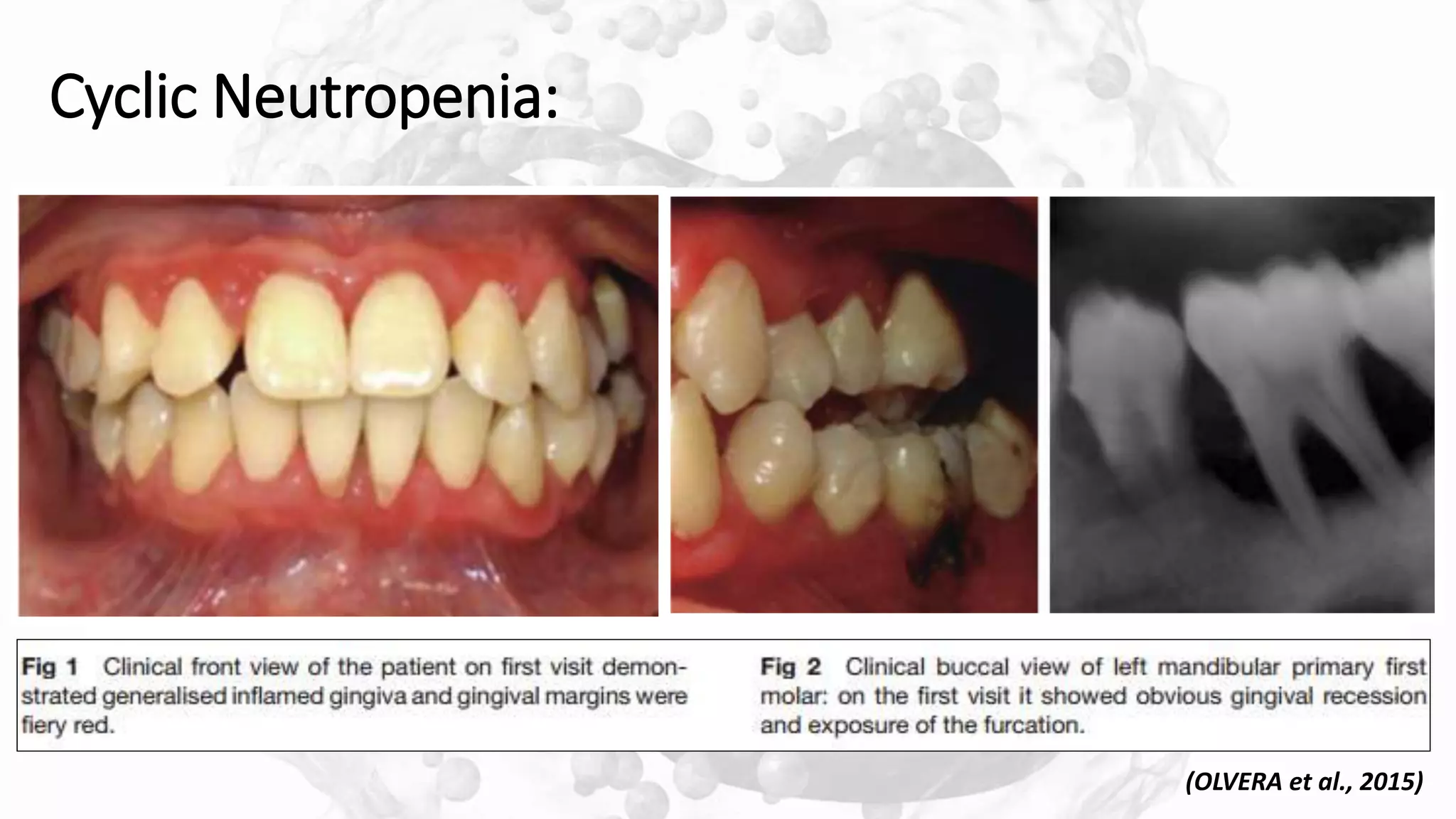 PMN DISORDERS & PERIODONTAL DISEASES | PPTX