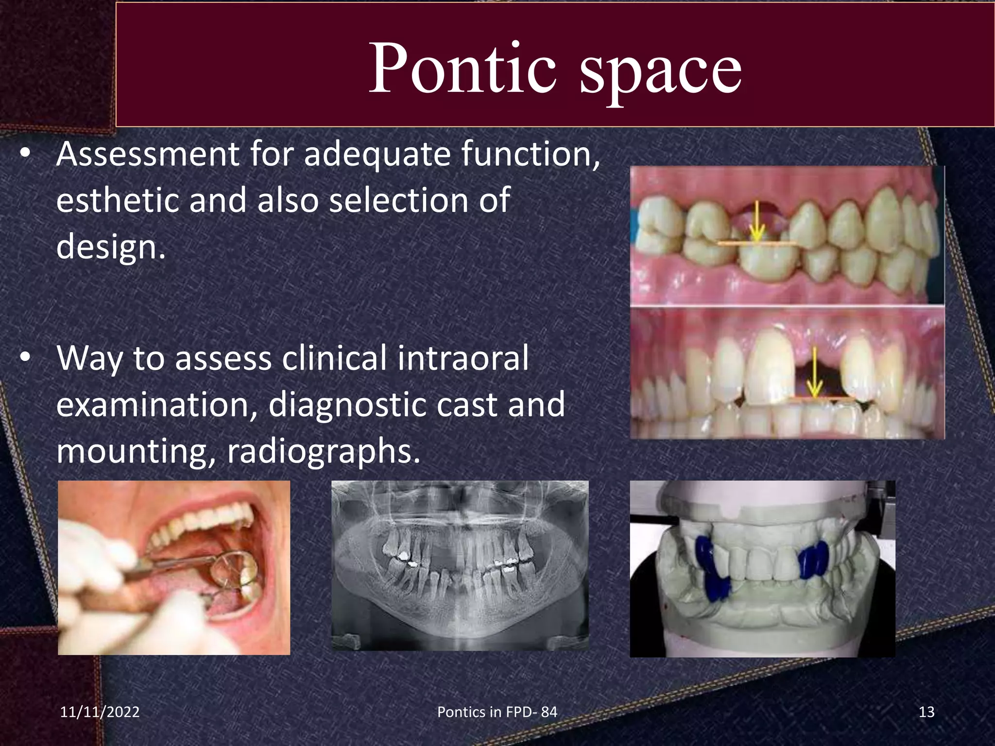 8 Pontics IN FPD.pptx