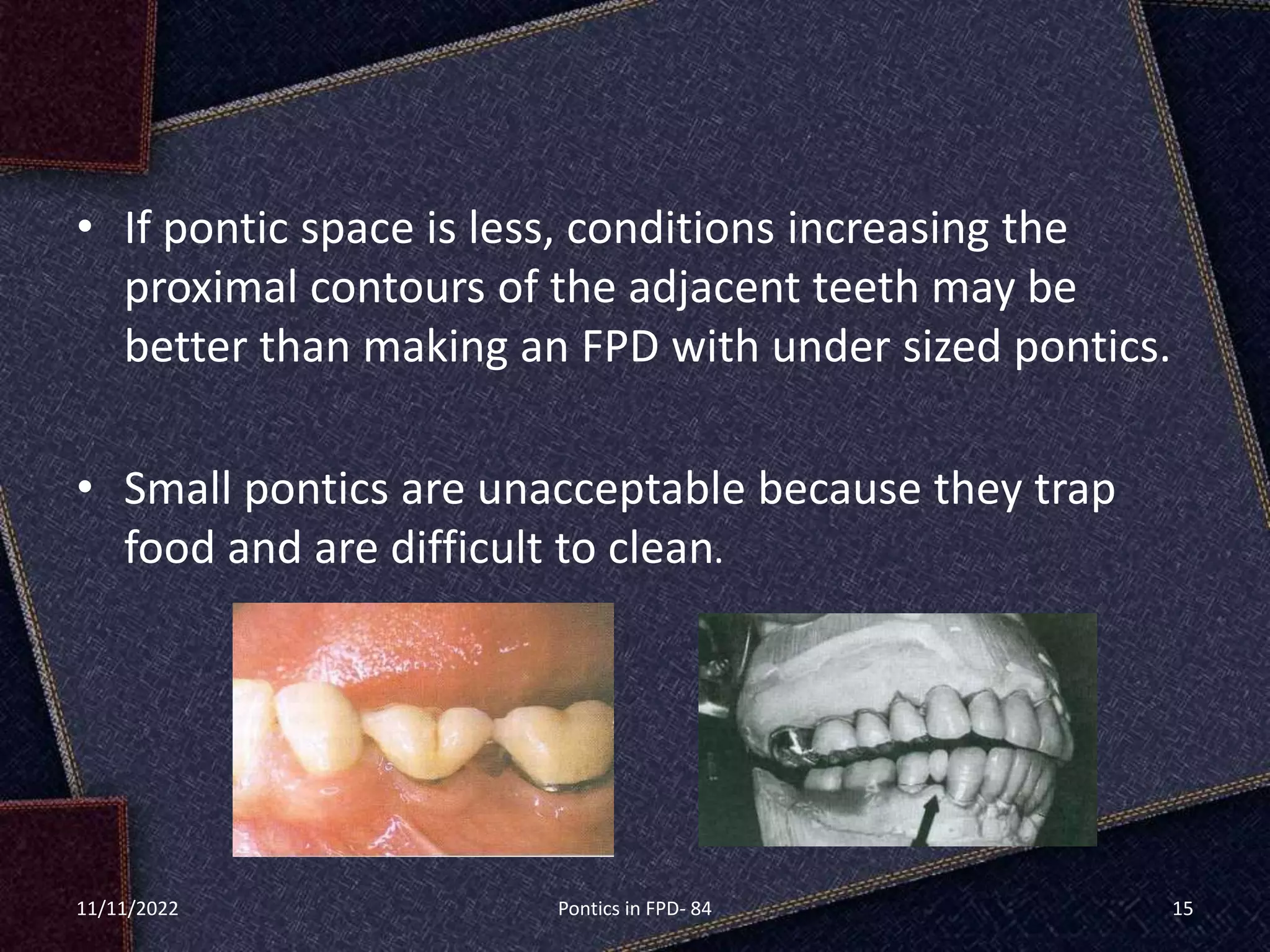 8 Pontics IN FPD.pptx