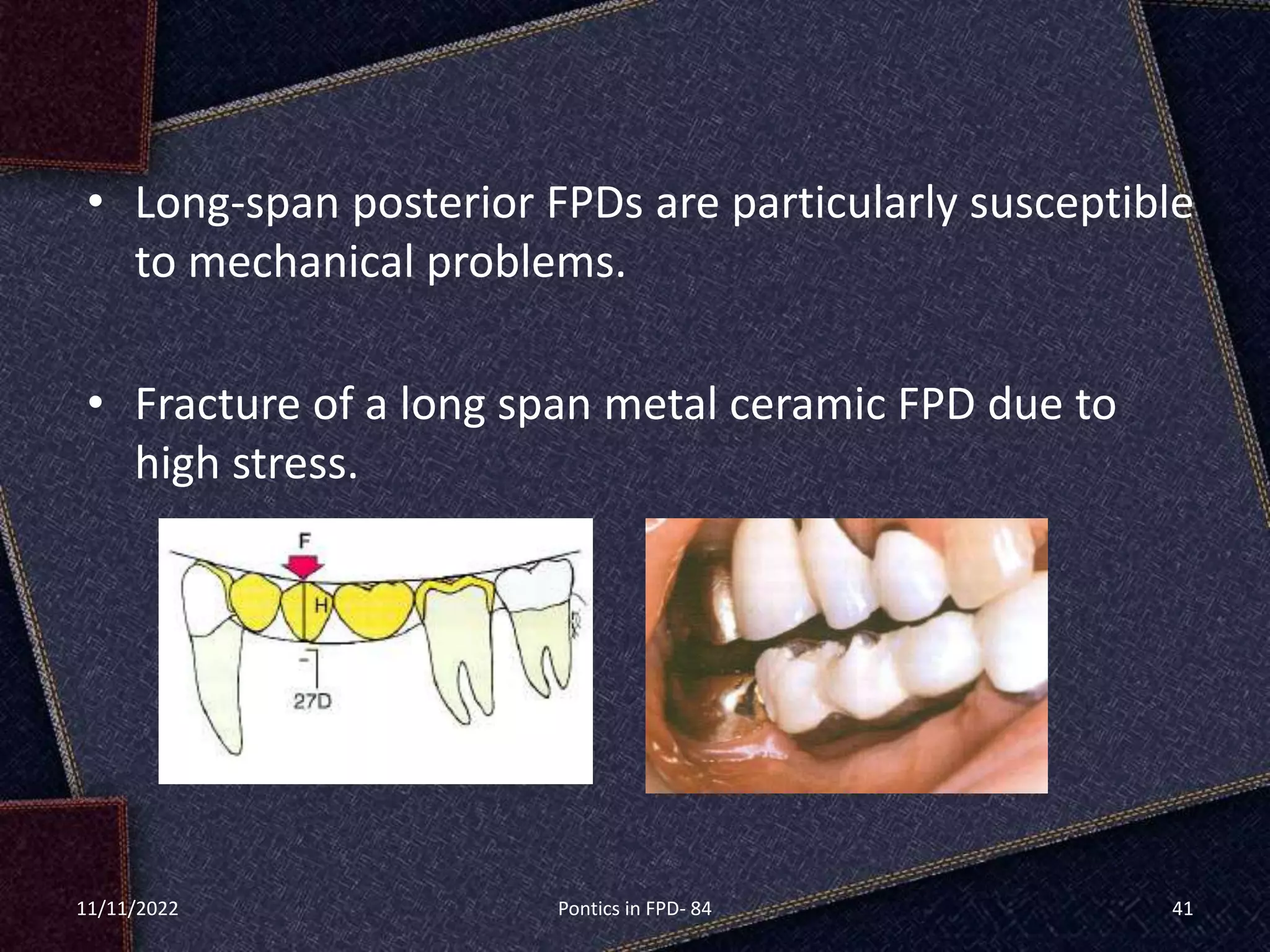 8 Pontics IN FPD.pptx