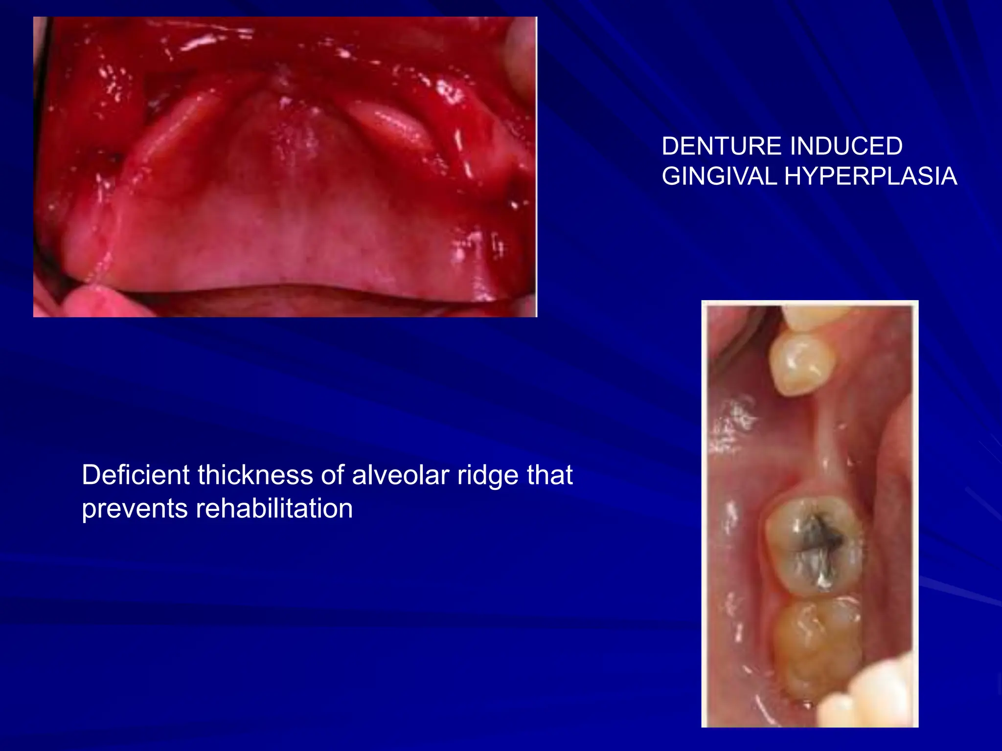 Preprosthetic surgery in prostho new.....ppt