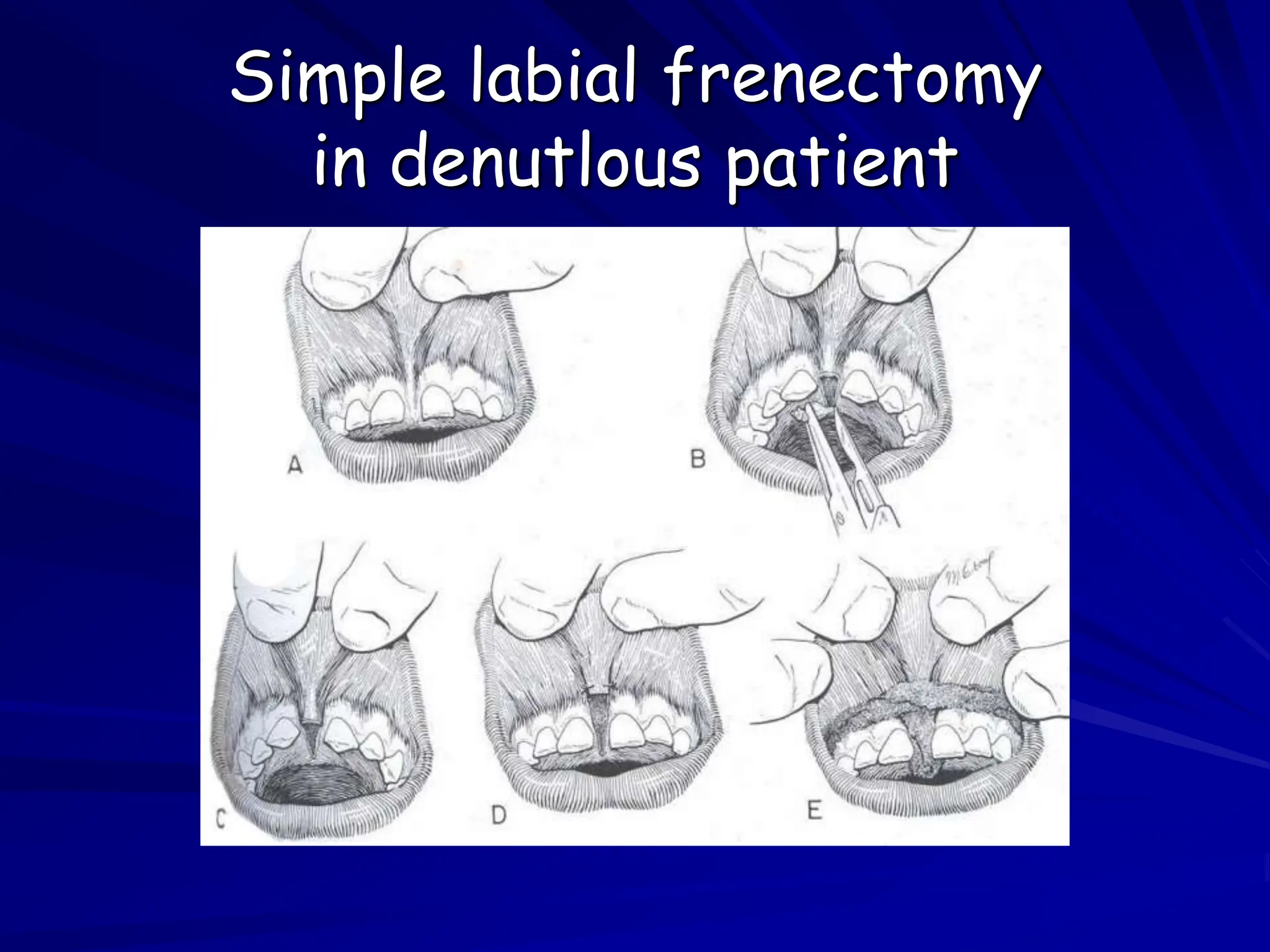 Preprosthetic surgery in prostho new.....ppt