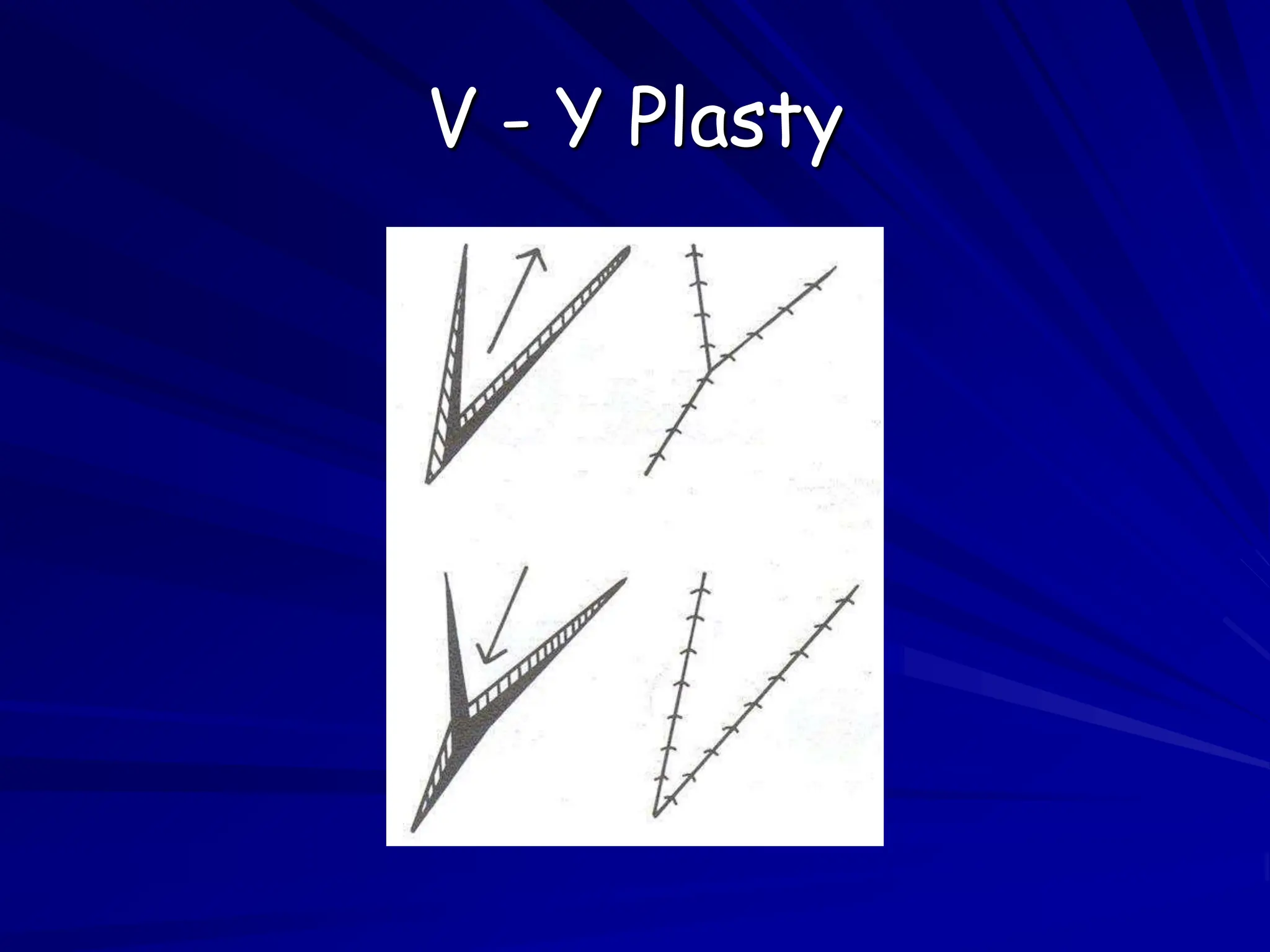 Preprosthetic surgery in prostho new.....ppt