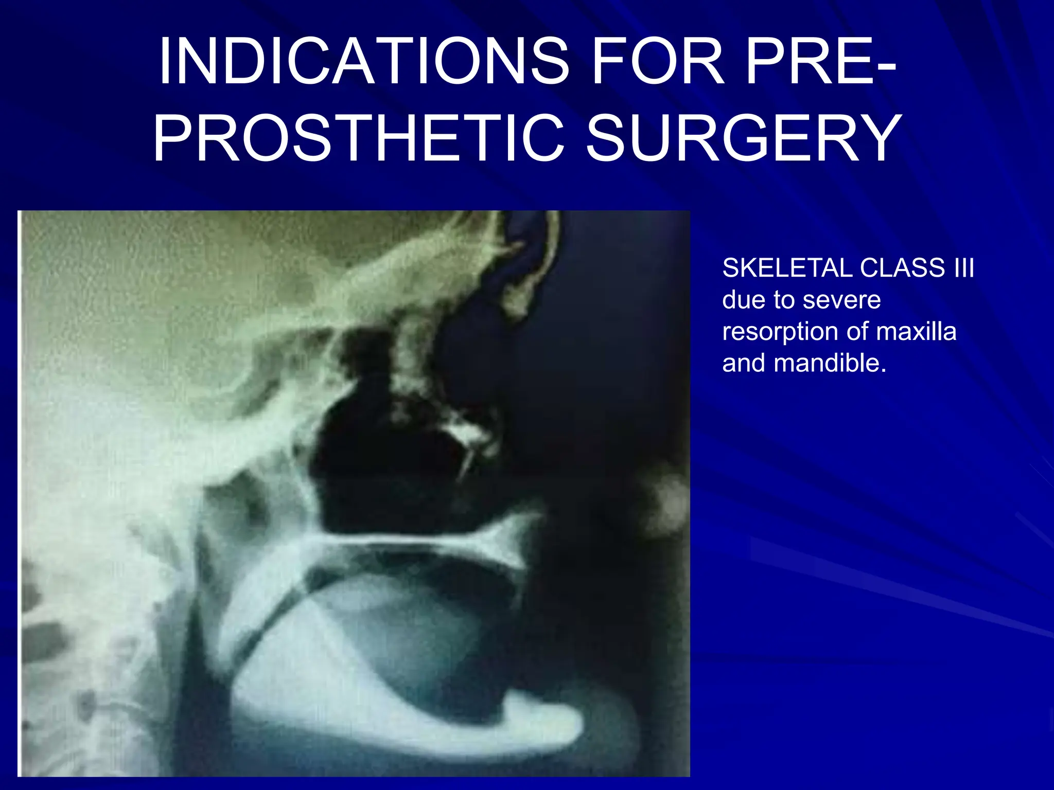 Preprosthetic surgery in prostho new.....ppt