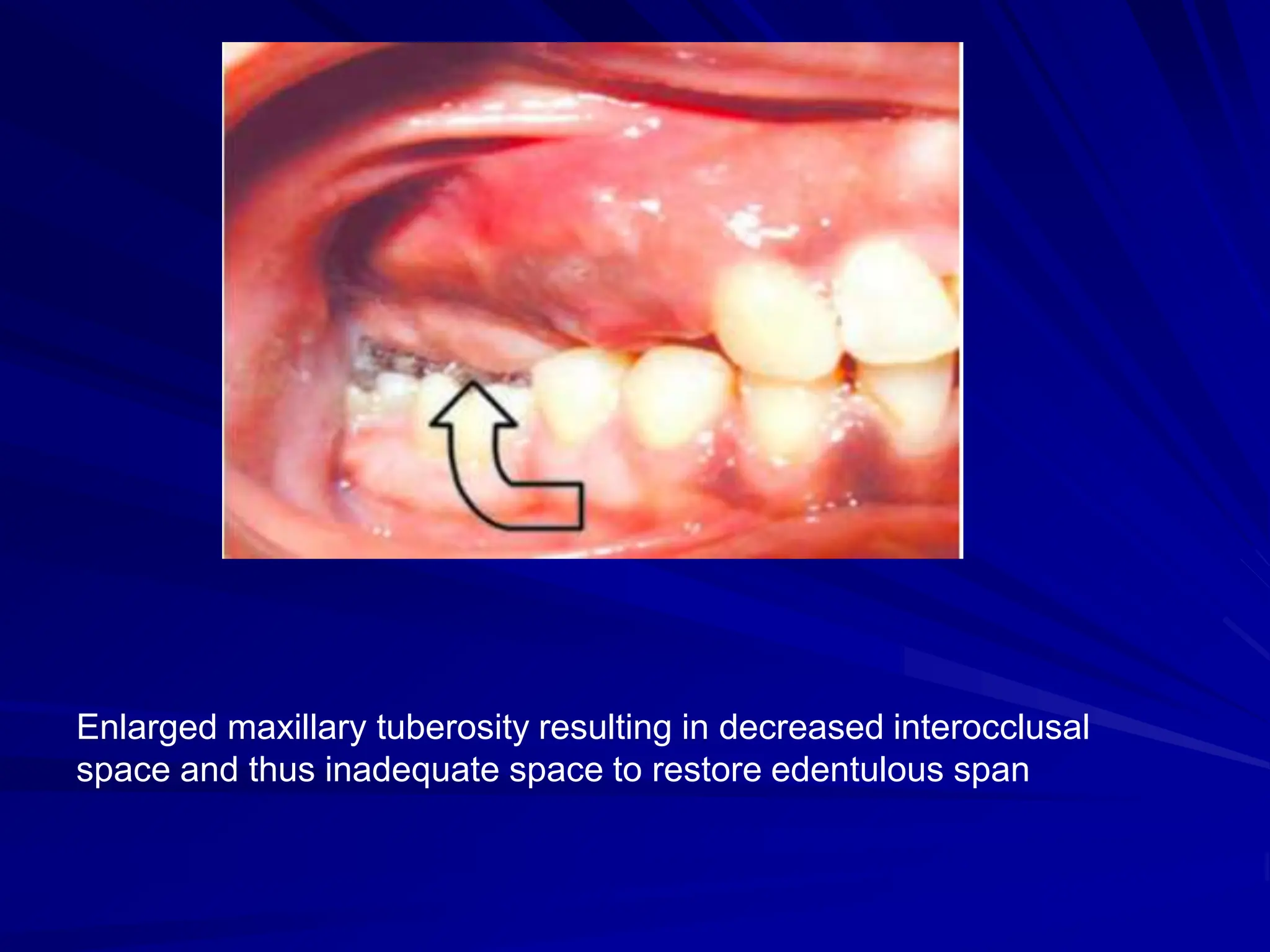 Preprosthetic surgery in prostho new.....ppt