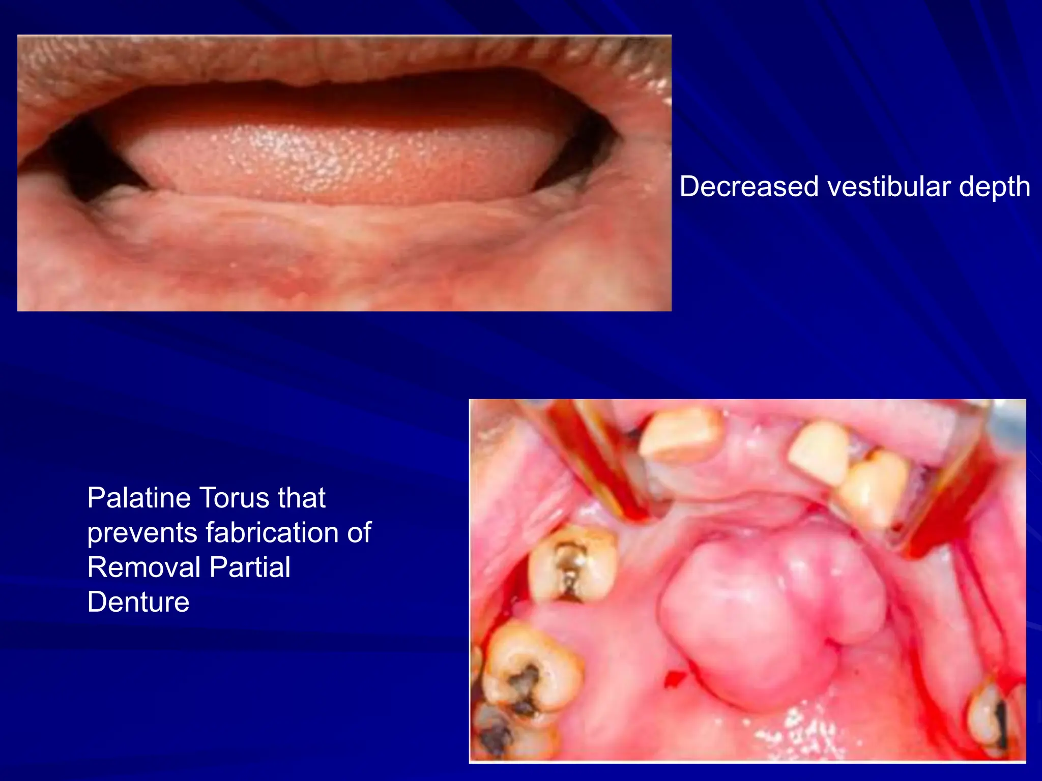 Preprosthetic surgery in prostho new.....ppt