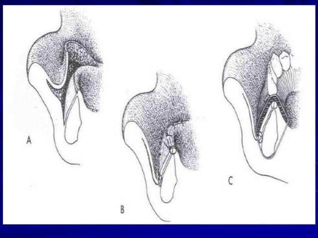 Preprosthetic surgery in prostho new.....ppt