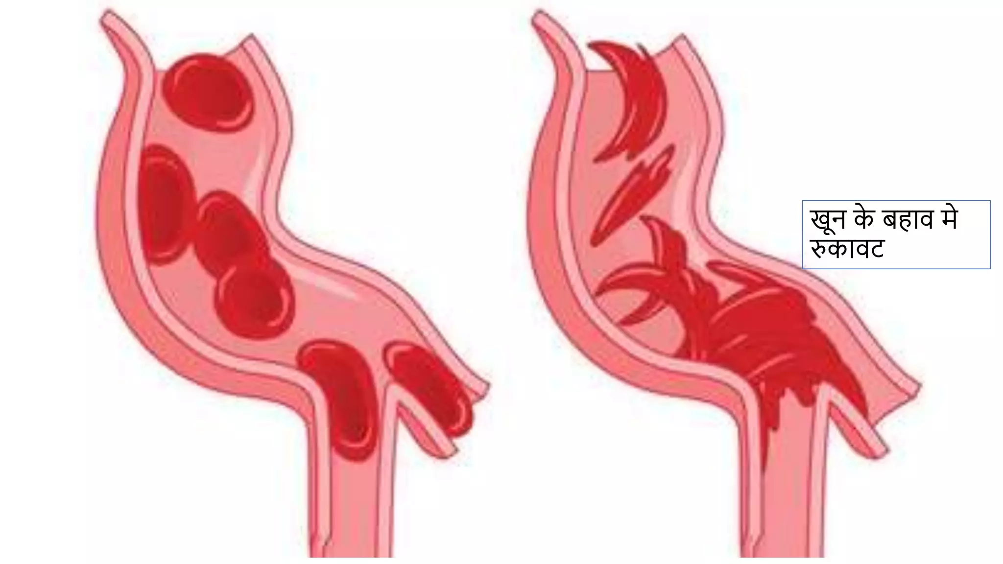 Sickle cell disease nursing care.pptx