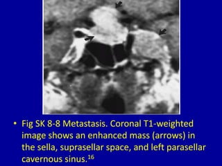 8 sellar and juxtasellar masses on magnetic resonance | PPT