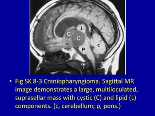 8 sellar and juxtasellar masses on magnetic resonance | PPT
