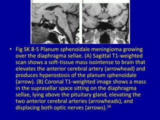 8 sellar and juxtasellar masses on magnetic resonance | PPT