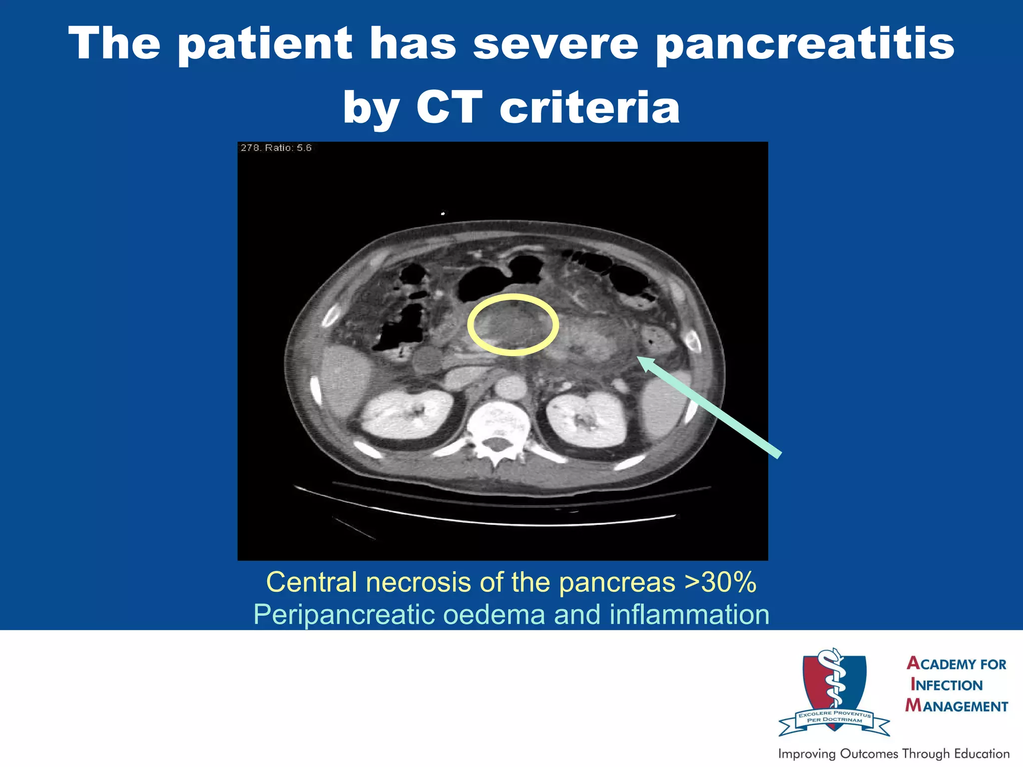 8 Severe Acute Pancreatitis | PPT