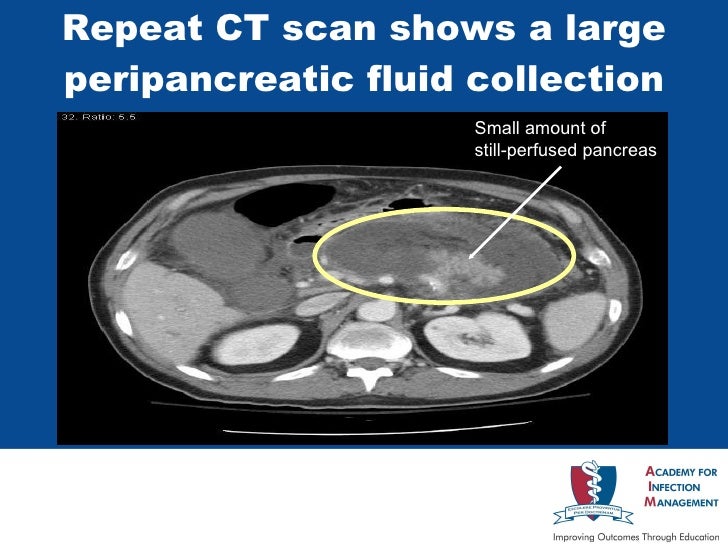 8 Severe Acute Pancreatitis