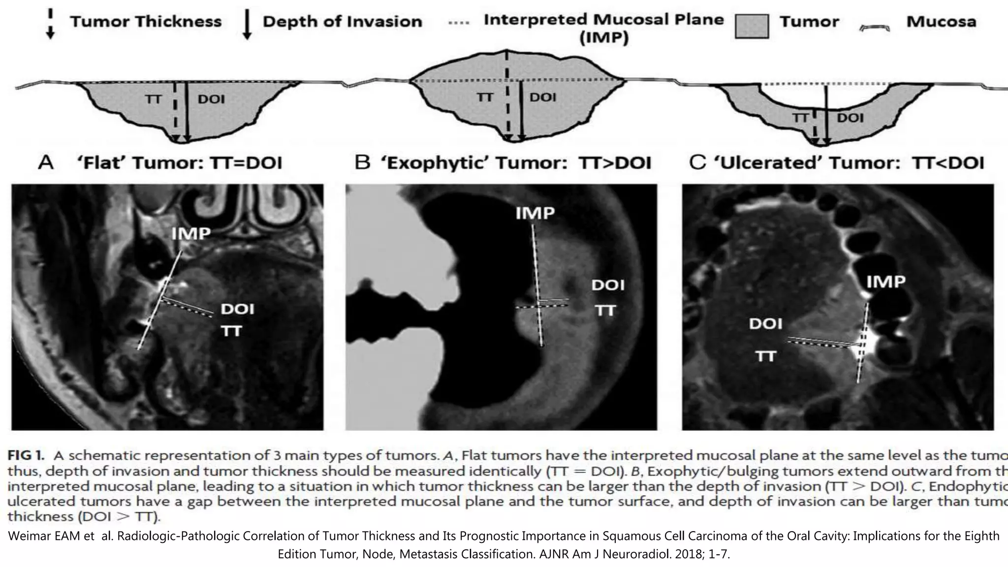 8 th edition TNM classification and significance of depth of invasion ...