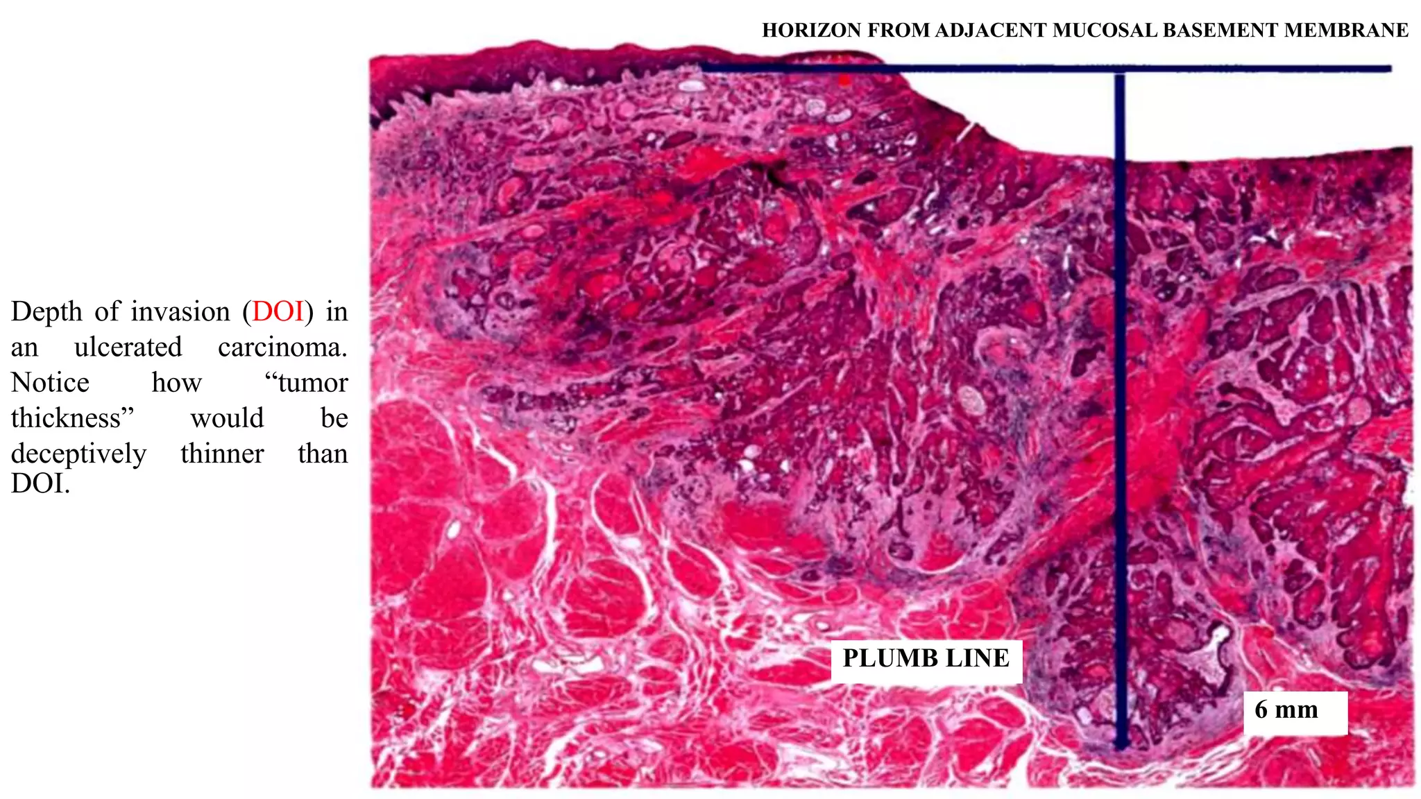 8 th edition TNM classification and significance of depth of invasion ...