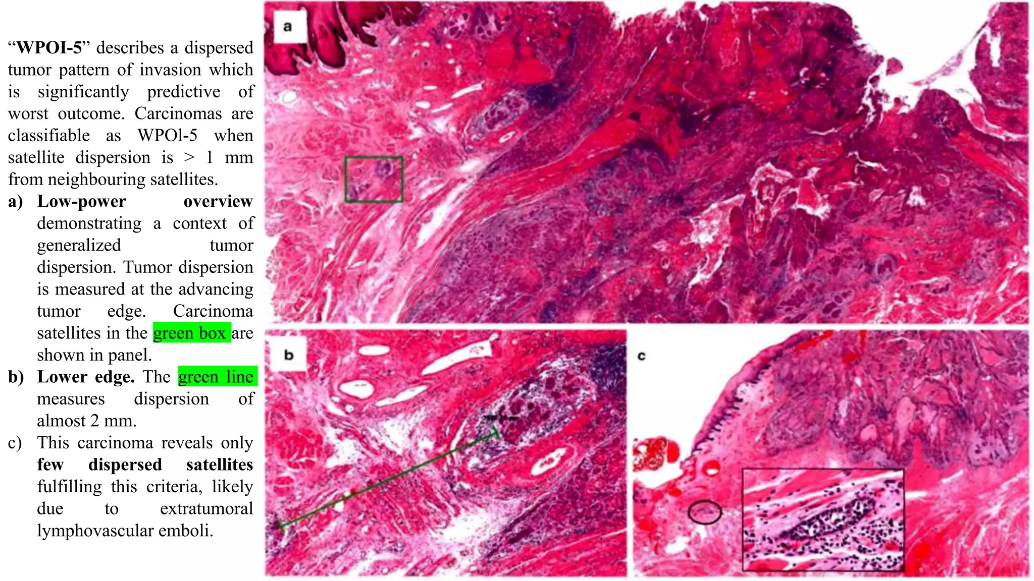 8 th edition TNM classification and significance of depth of invasion ...