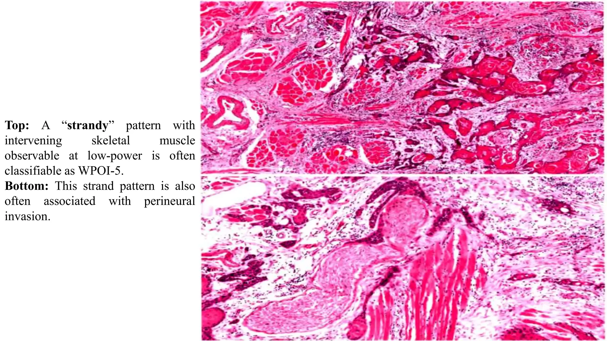 8 th edition TNM classification and significance of depth of invasion ...