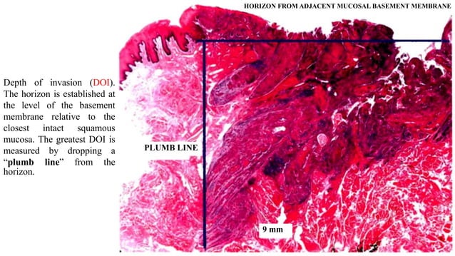 8 th edition TNM classification and significance of depth of invasion ...