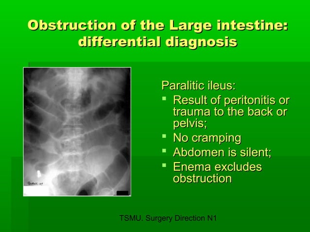 large intestine | PPT | Digestive Disorders | Diseases and Conditions